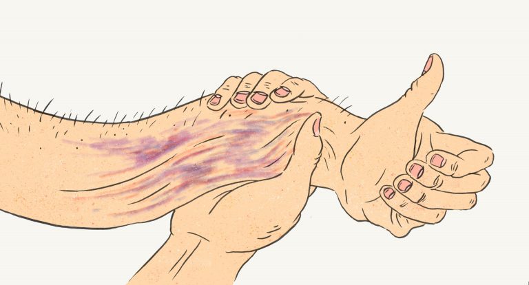 THE JENKEM GUIDE TO SKATE INJURIES - Jenkem Magazine